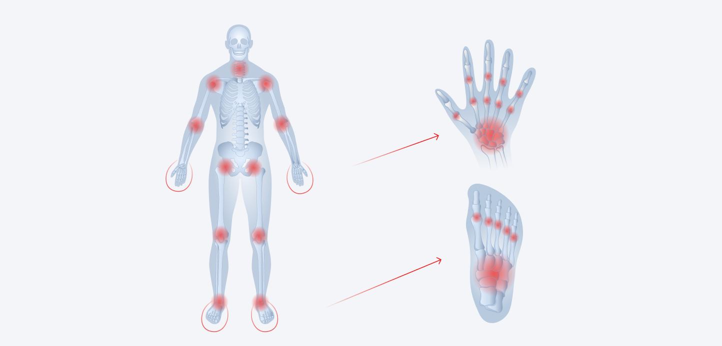Rheumatoide Arthritis - Definition | MSD Gesundheit Schweiz