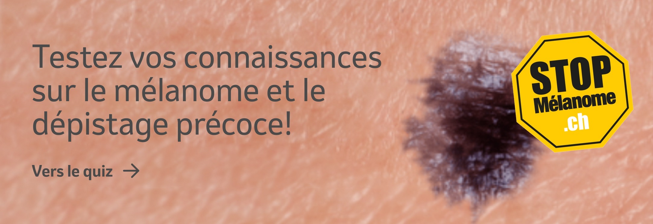 Mélanome - Prévention et dépistage | MSD Santé Suisse