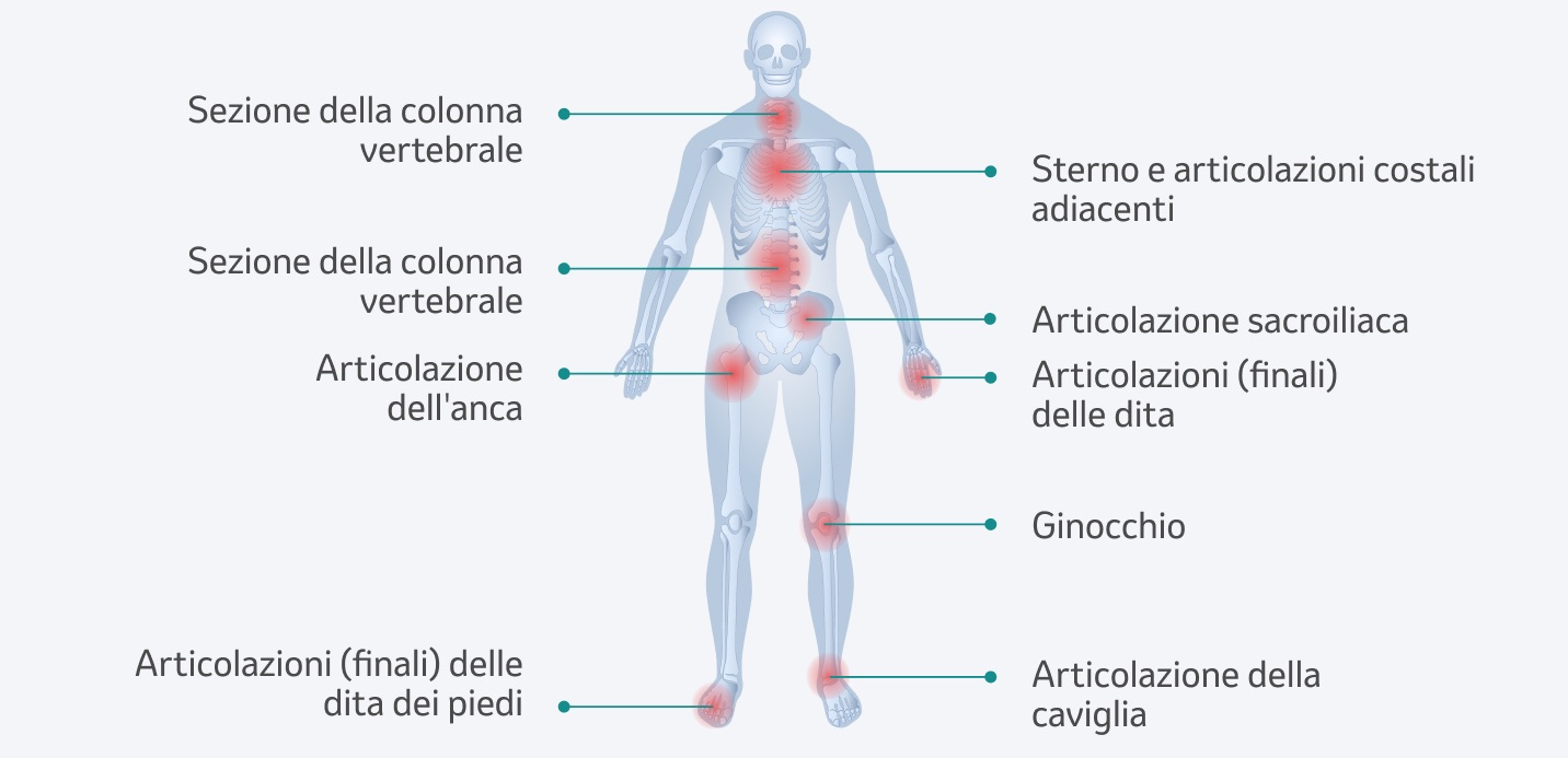 L'artrite psoriasica - Definizione | MSD Salute Svizzera