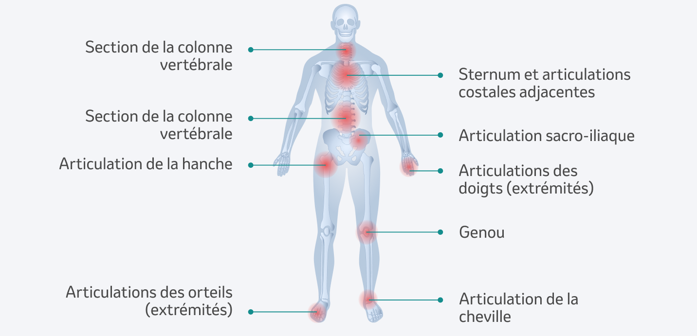 Arthrite psoriasique - Définition | MSD Santé Suisse